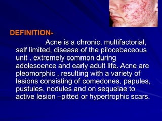 acne.ppt pharmacotherapy for treating acne | PPT