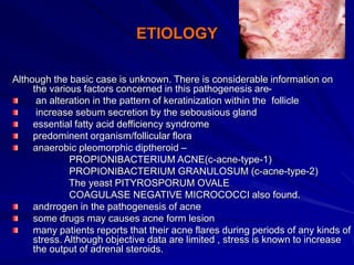 acne.ppt pharmacotherapy for treating acne | PPT