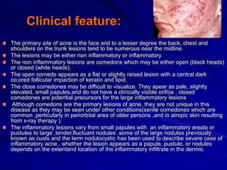 acne.ppt pharmacotherapy for treating acne | PPT