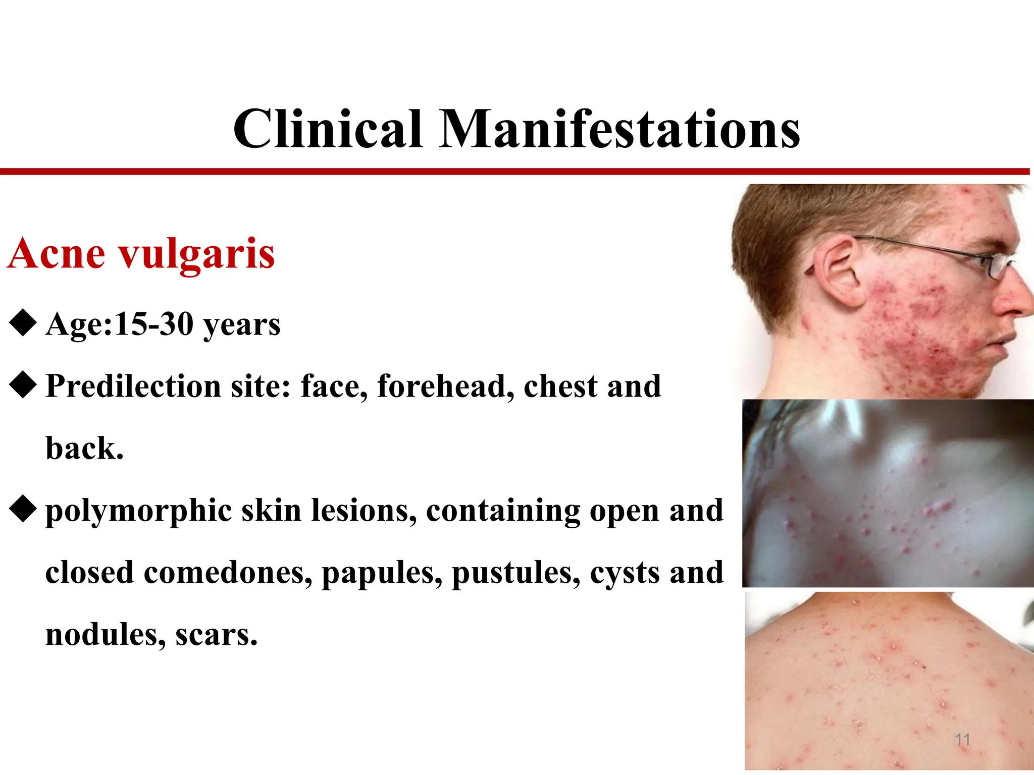 Acne in adults and children , causes , treatment.ppt