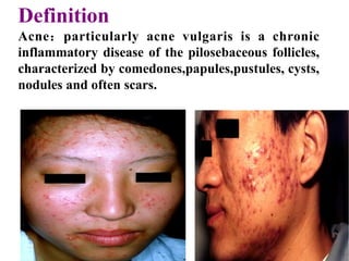 Acne in adults and children , causes , treatment.ppt