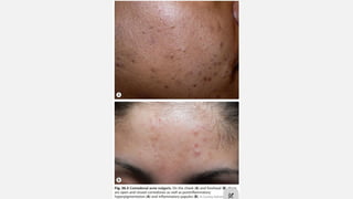 Acne- pathophysiology and types of acne. | PPTX