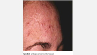 Acne- pathophysiology and types of acne. | PPTX