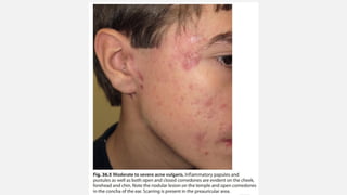 Acne- pathophysiology and types of acne. | PPTX