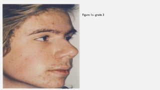 Acne- pathophysiology and types of acne. | PPTX