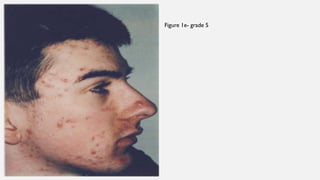 Acne- pathophysiology and types of acne. | PPTX