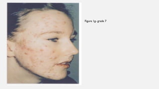 Acne- pathophysiology and types of acne. | PPTX
