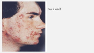 Acne- pathophysiology and types of acne. | PPTX