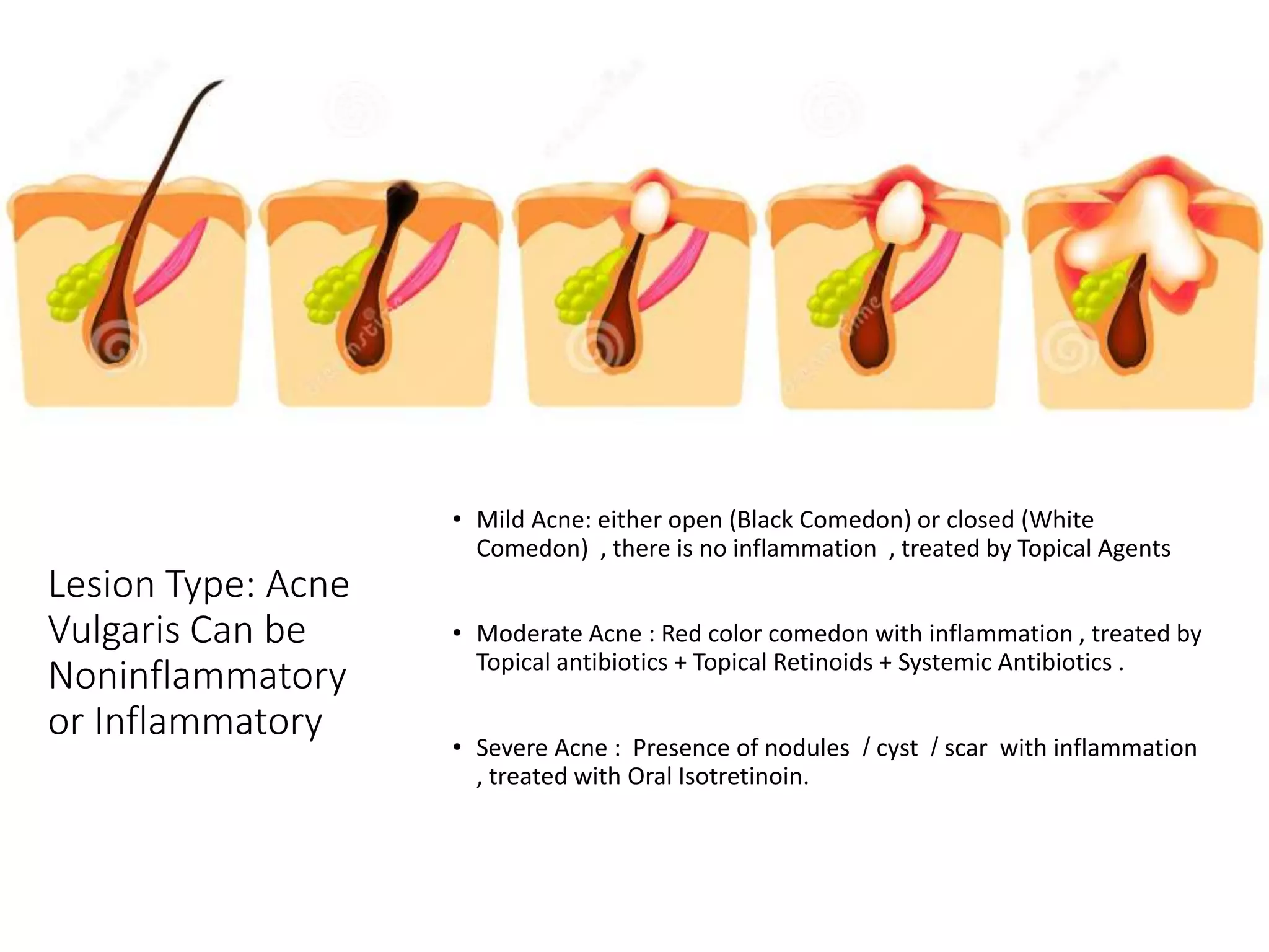 Acne vulgaris | PPTX