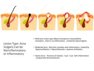 Acne vulgaris | PPTX