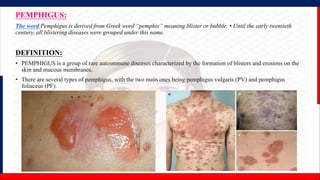 ACNE VULGARIS , ALLERGIES, ECZEMA, PEMPHIGUS.pdf