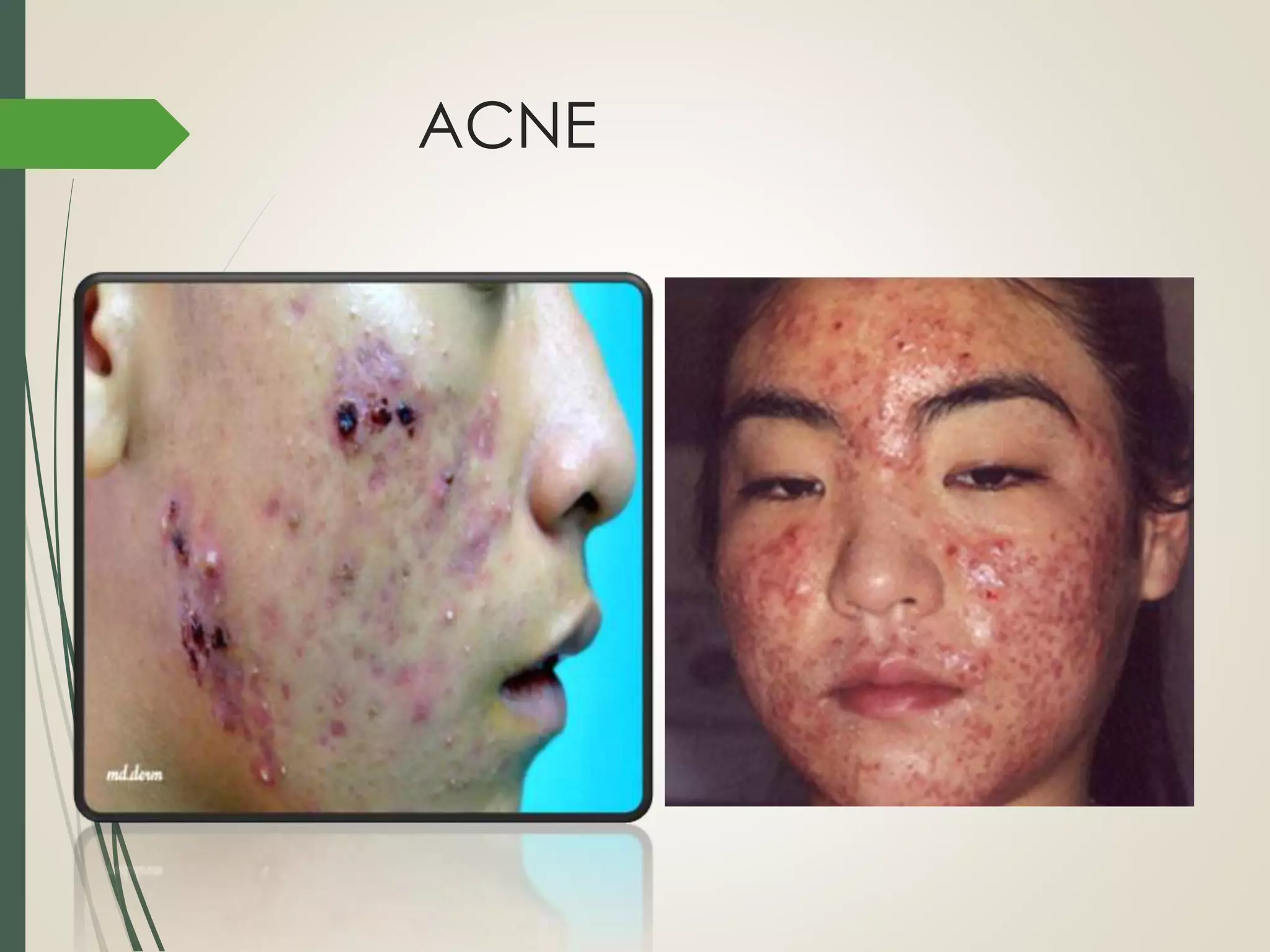 Acne and burns | PPTX | Skin and Dermatology | Diseases and Conditions