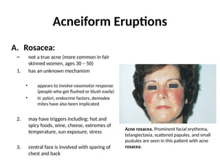 Acne and Disorders of Sebaceous Glands and Hair Clinical Pathology ...