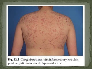 Rosacea On Back