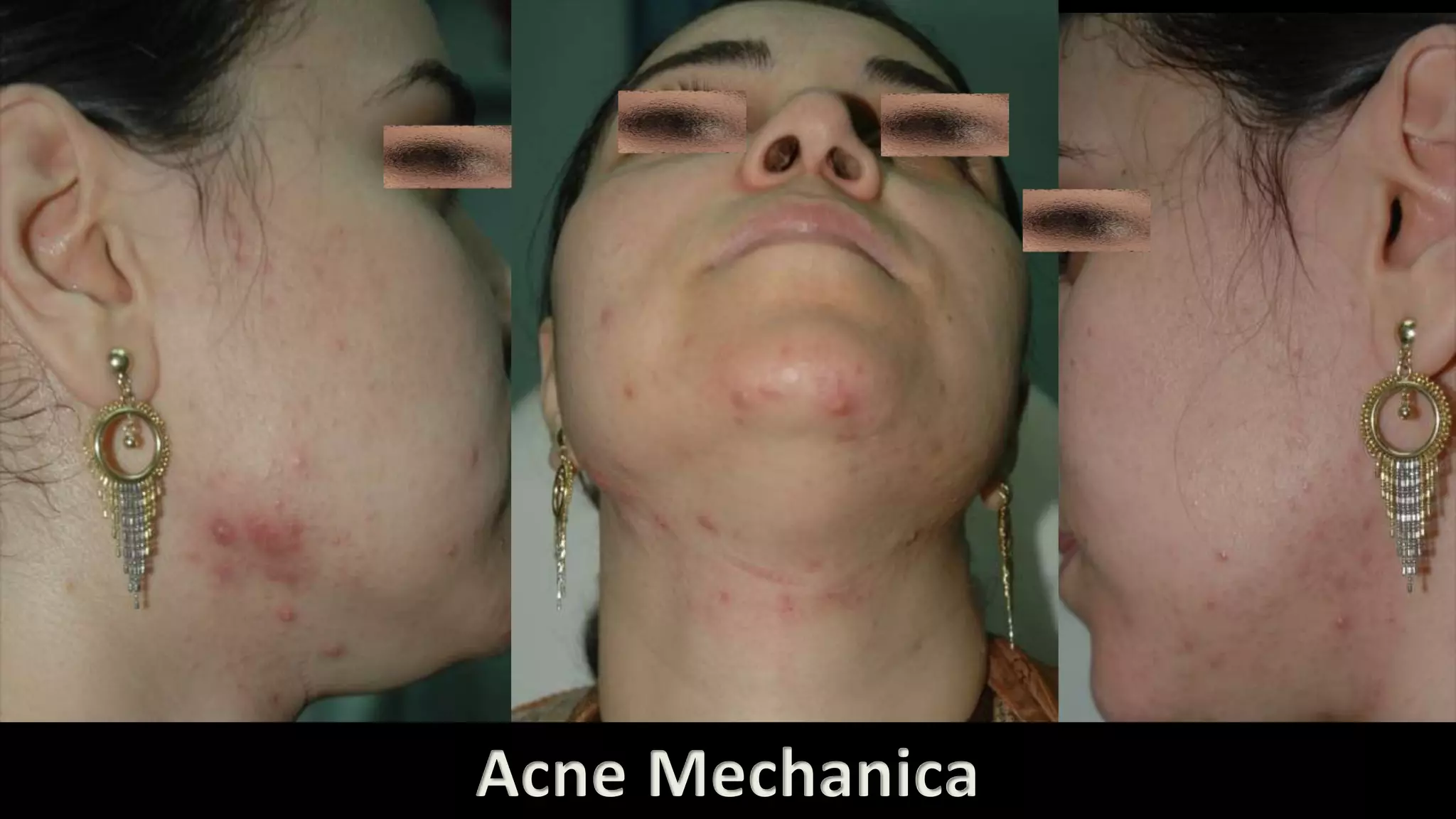 Acne Treatment. What is New? | PPSX