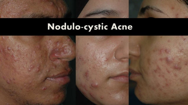 Mild Acne Fulminans