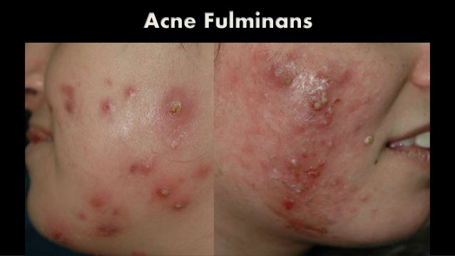 Mild Acne Fulminans