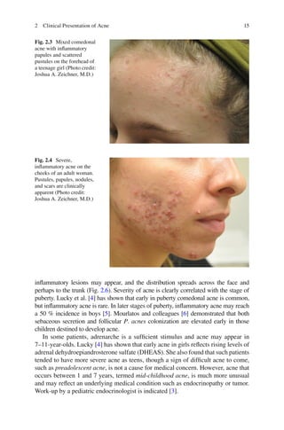Acneiform Eruptions in Dermatology_ A Differential Diagnosis. 2014.pdf