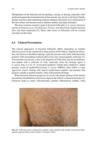 Acneiform Eruptions in Dermatology_ A Differential Diagnosis. 2014.pdf