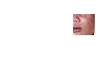 acneiform lesions.pptx