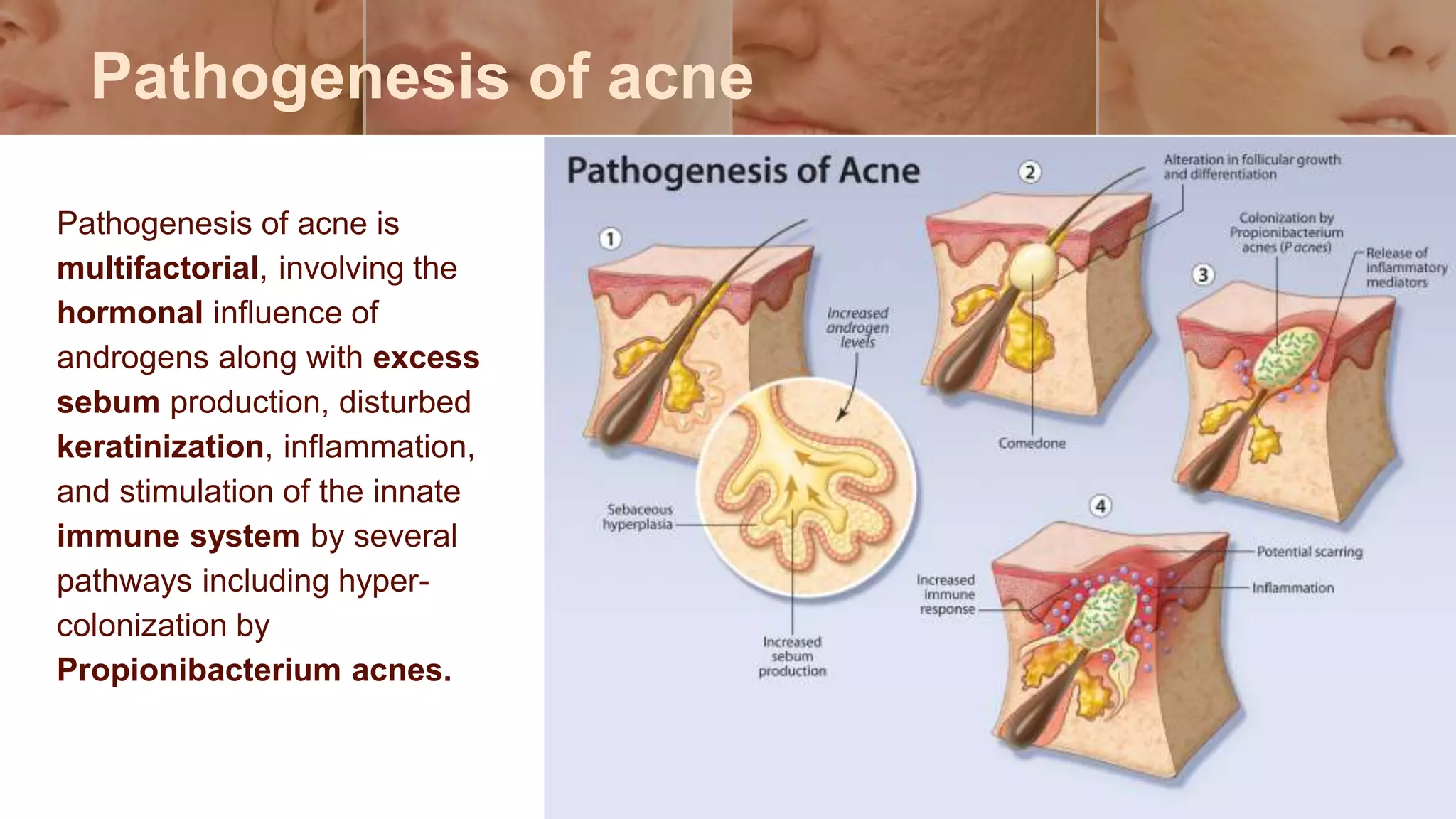 Practical guideline for the acne management | PPTX