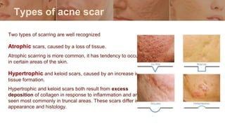 Practical guideline for the acne management | PPTX