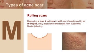 Practical guideline for the acne management | PPTX