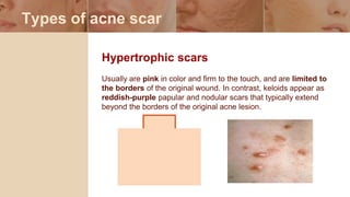 Practical guideline for the acne management | PPTX