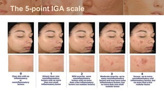 Practical guideline for the acne management | PPTX