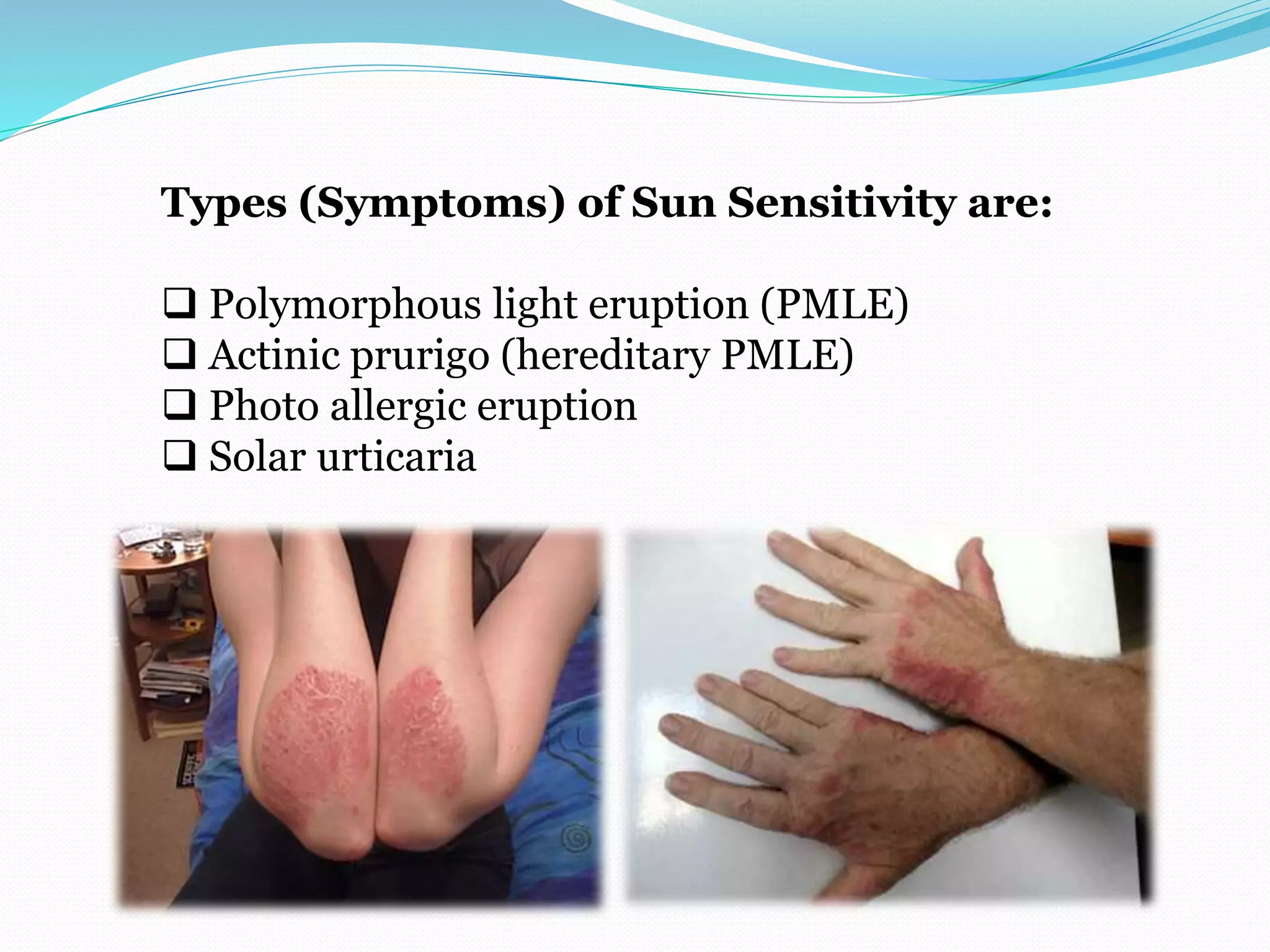 Acne Medications and Sun Sensitivity | PPTX
