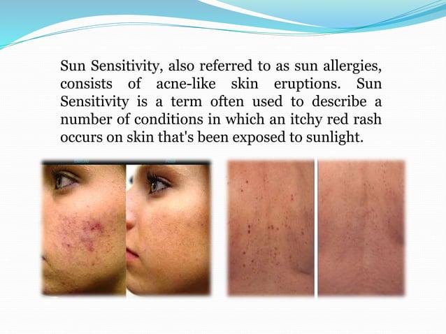 Acne Medications and Sun Sensitivity | PPTX