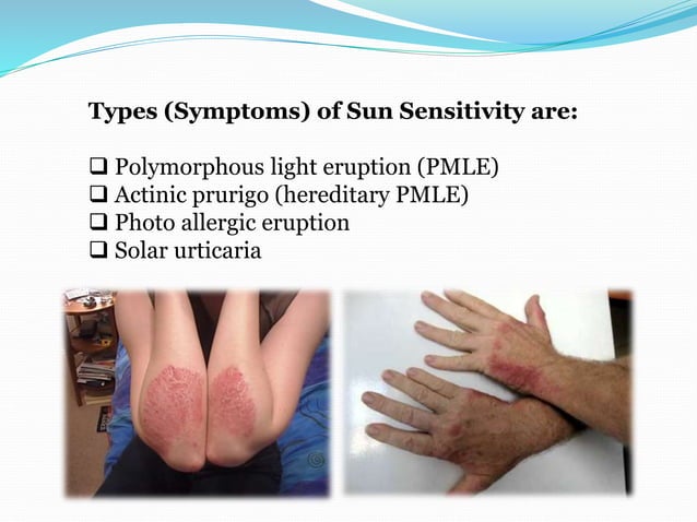 Acne Medications and Sun Sensitivity | PPTX