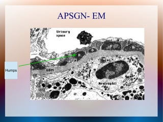Ac nephritic synd | ODP | Blood Disorders | Diseases and Conditions