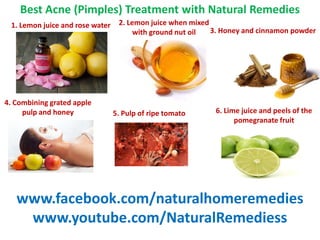 Acne & pimples home remedies treatment | PPTX