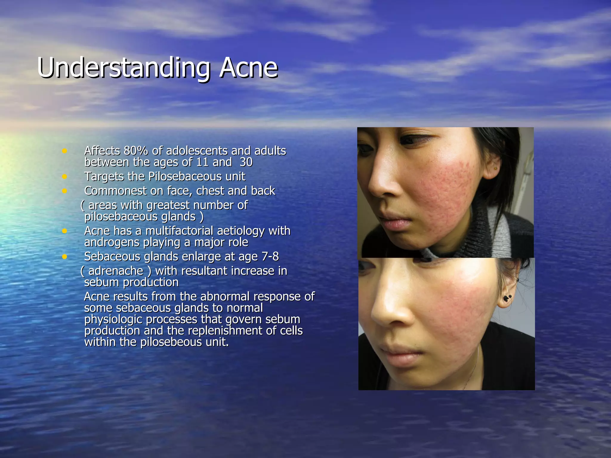 Managing Acne & Acne Scarring - Clearskincare | PPT