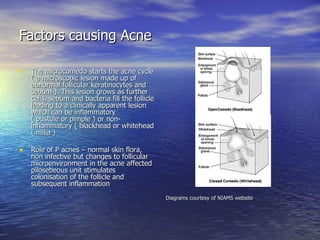 Managing Acne & Acne Scarring - Clearskincare | PPT