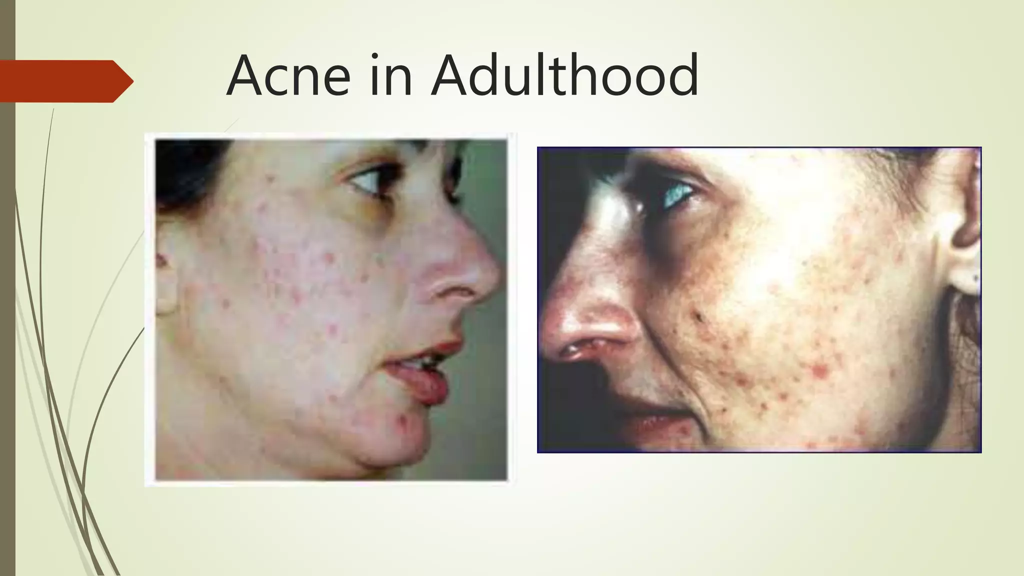 Acne presentation | PPTX | Pregnancy | Reproductive Health