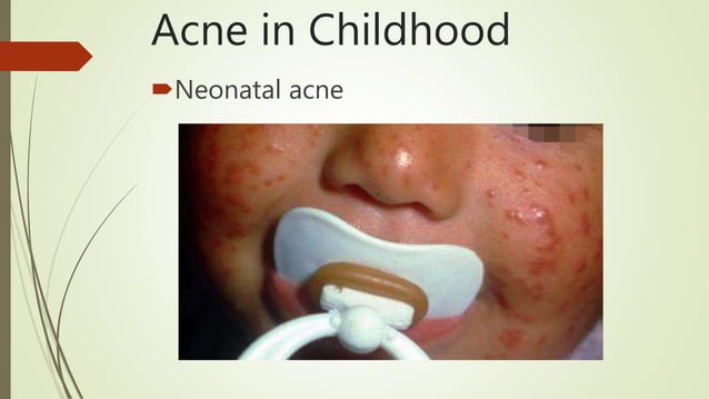 Acne presentation | PPT