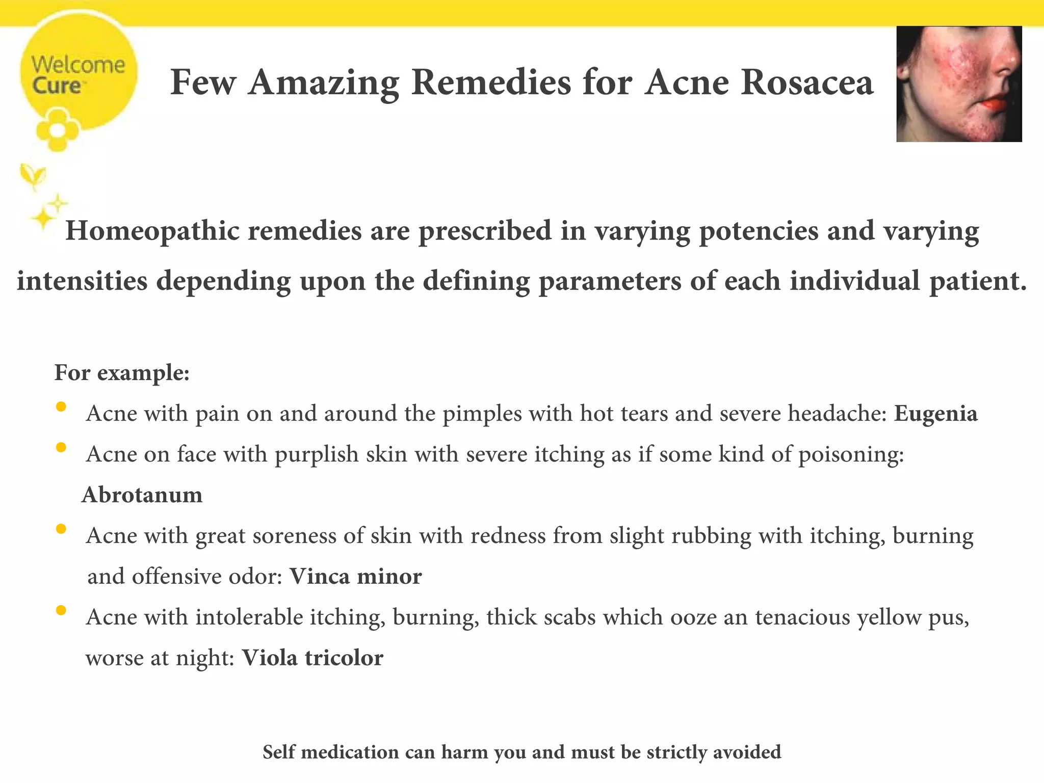 Acne Rosacea- The Disease, Its Complications And Homeopathic Treatment ...