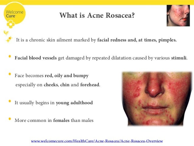 Acne caused by rosacea, skin peels for acne at home