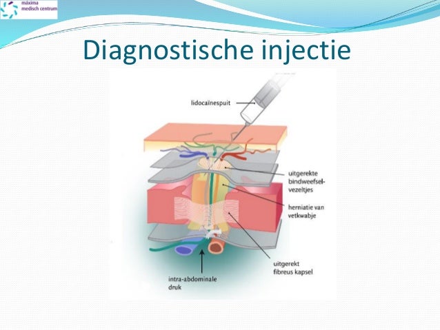 Diagnostiek en behandeling ACNES