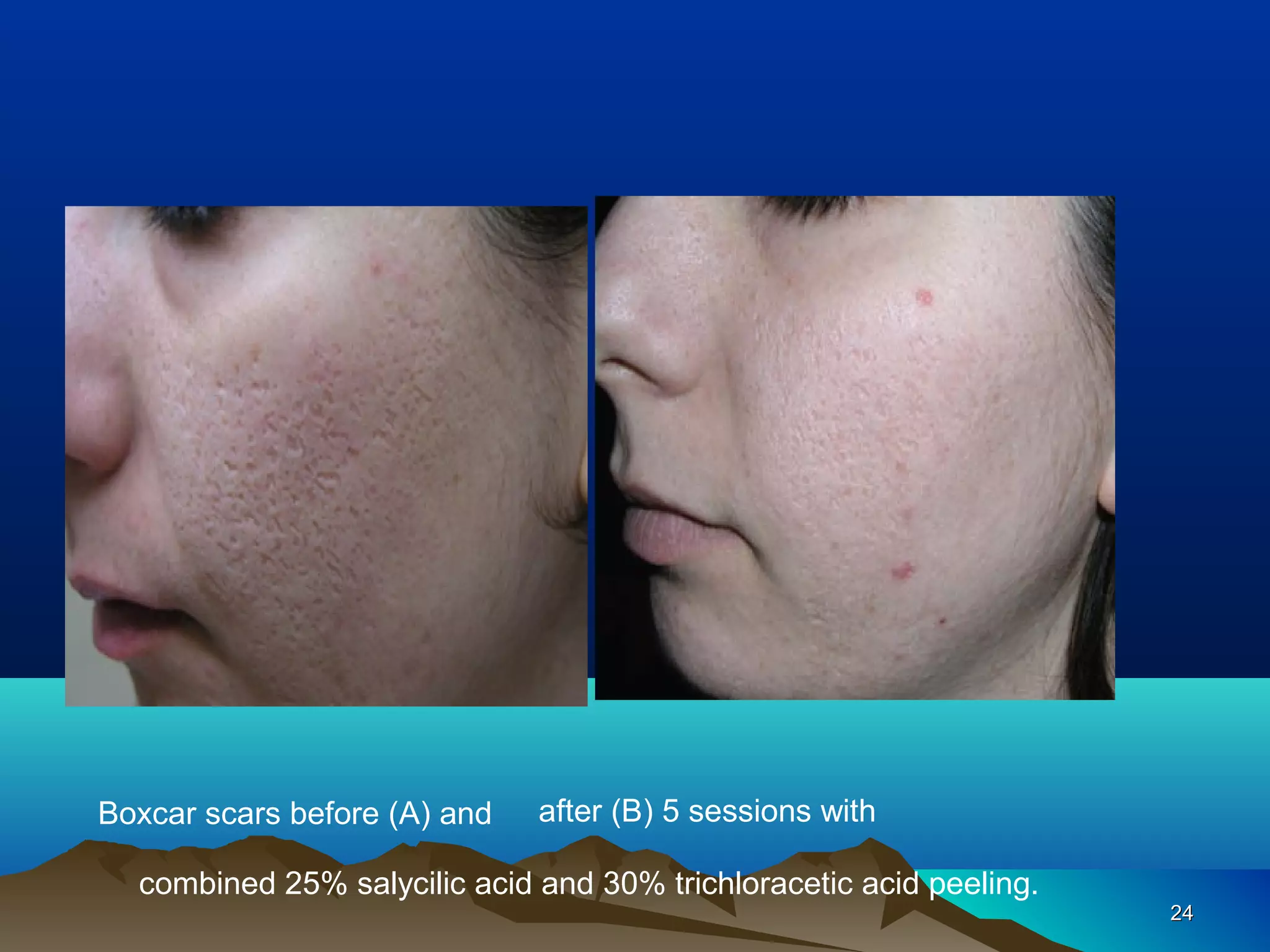 Acne scar treatment | PPT