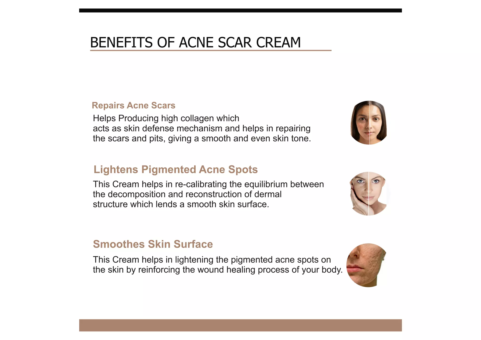 Removes All Types Of Scars, Pits, Pimples With Zenvista Acne Scar ...