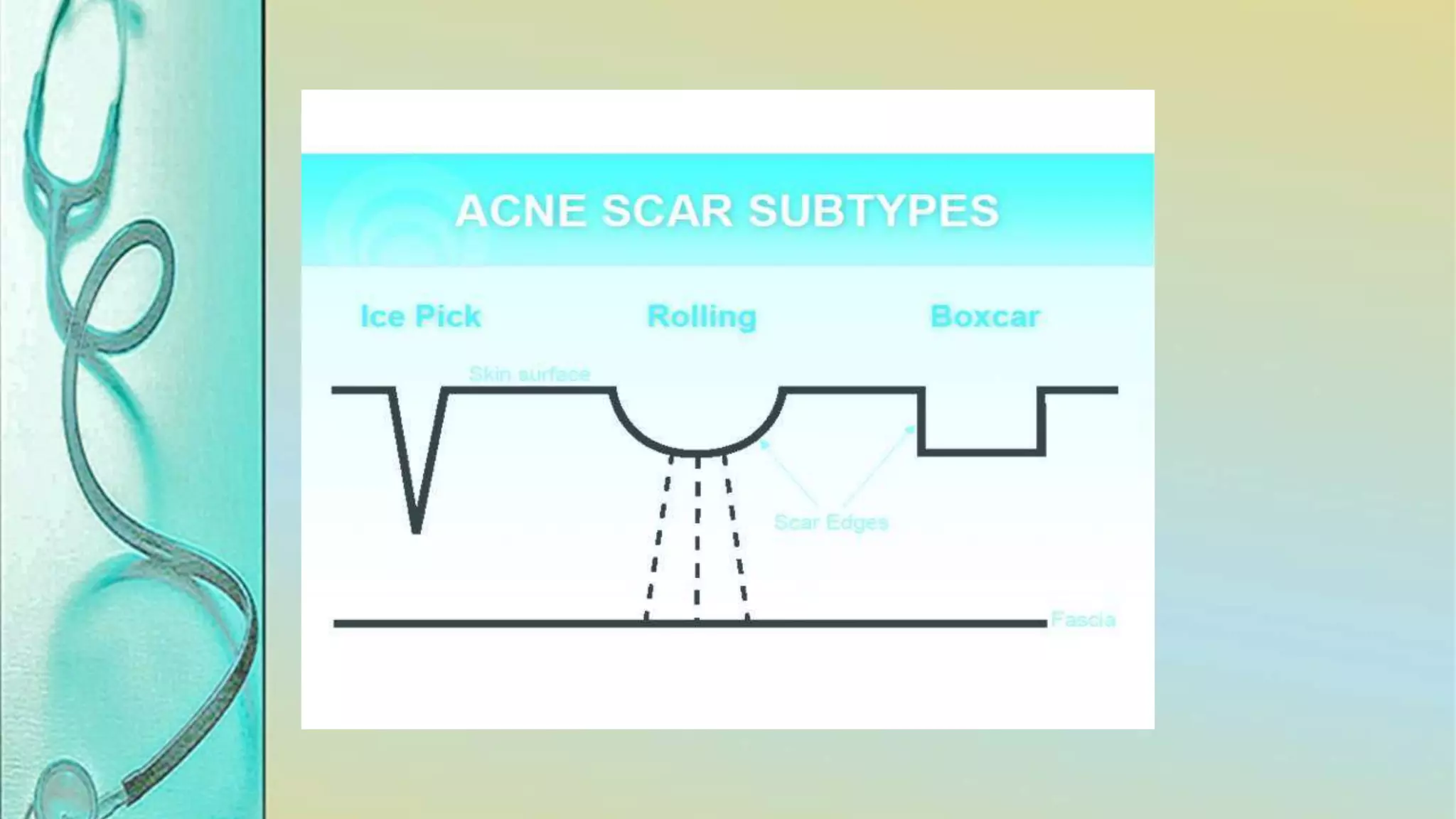 surgical management of acne scars | PPTX