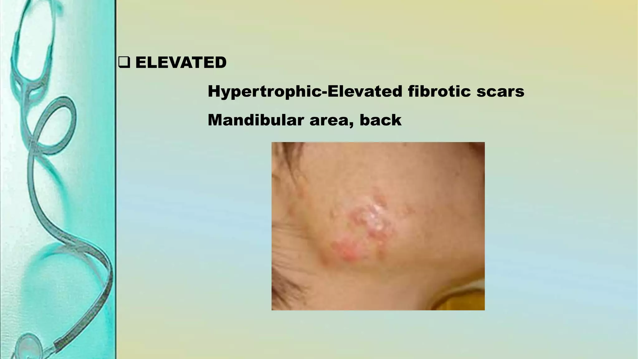 surgical management of acne scars | PPTX