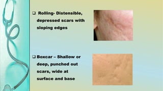 surgical management of acne scars | PPTX