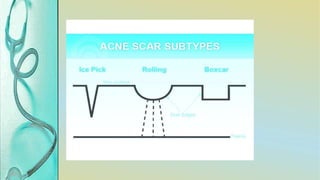 surgical management of acne scars | PPTX