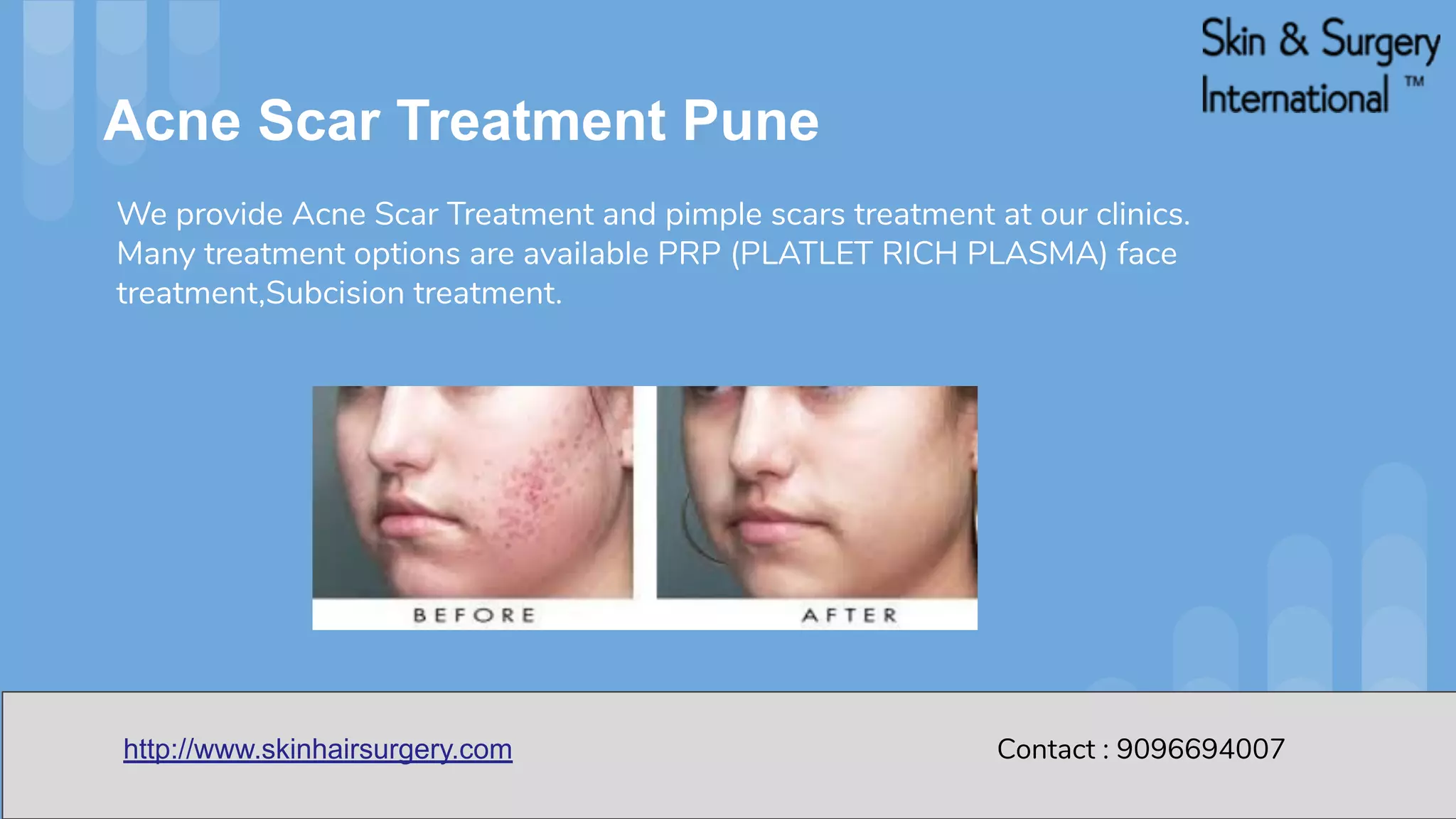 Acne scar treatment pune | PDF