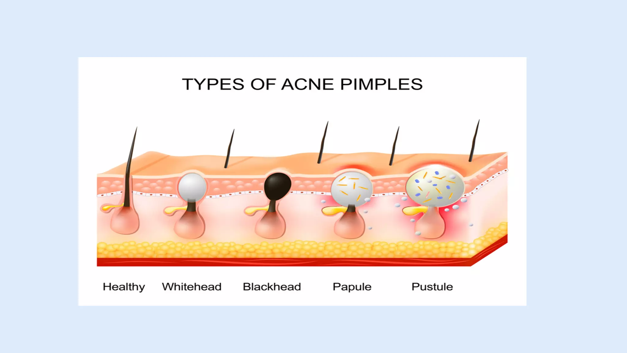 Acne Scar Treatments.pdf