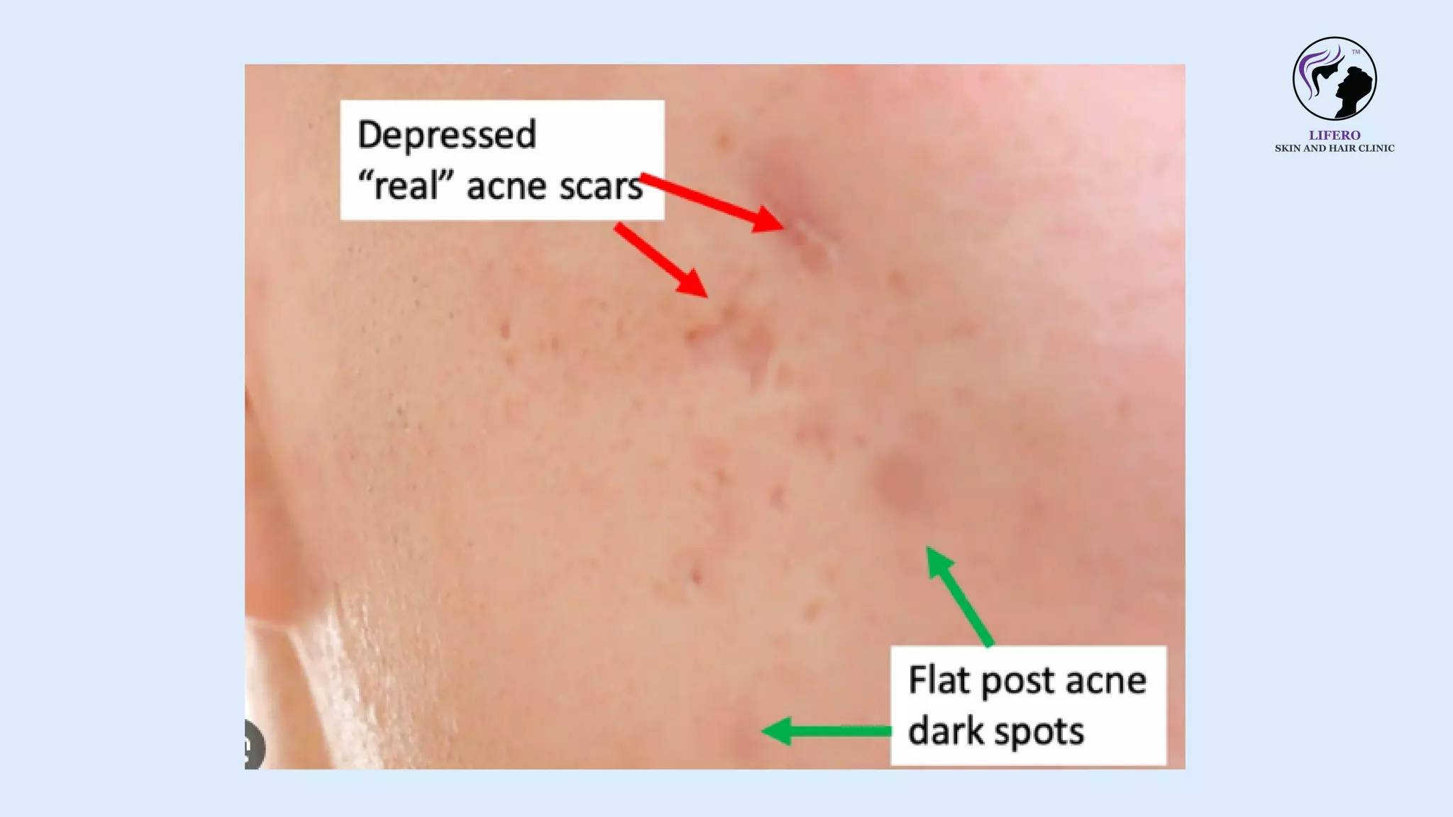 Acne Scar Treatments.pdf